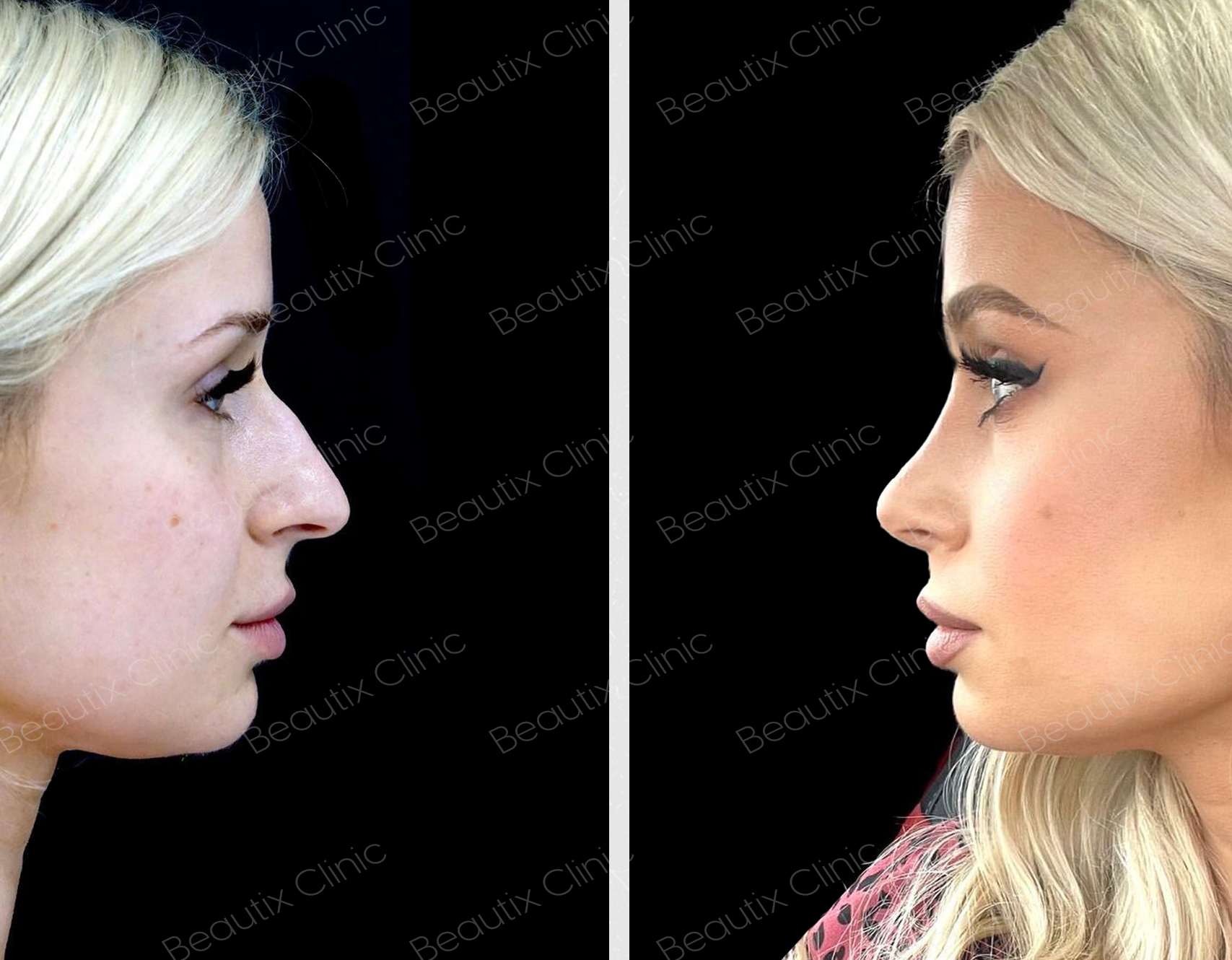 RHINOPLASTY – Beautix Clinic